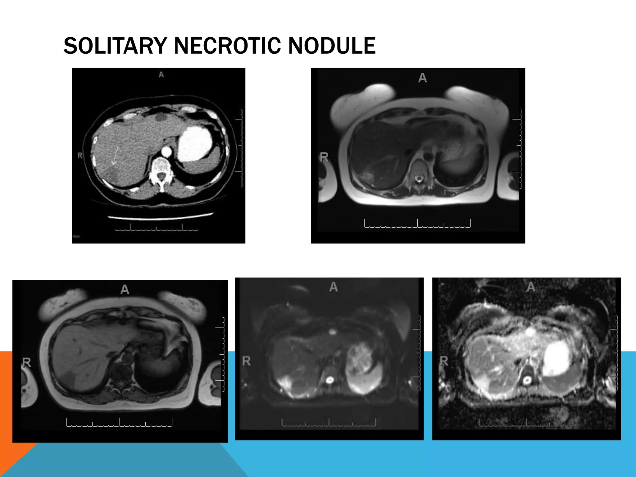 Quick review of hepatobiliary and pancreatic lesion | PPTX
