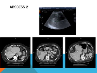 Quick review of hepatobiliary and pancreatic lesion | PPTX
