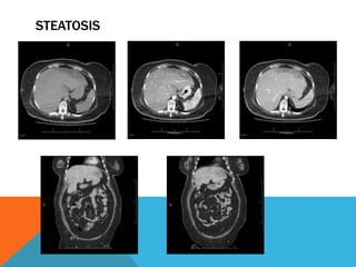 Quick review of hepatobiliary and pancreatic lesion | PPTX