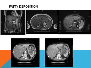 Quick review of hepatobiliary and pancreatic lesion | PPTX