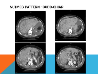 Quick review of hepatobiliary and pancreatic lesion | PPTX