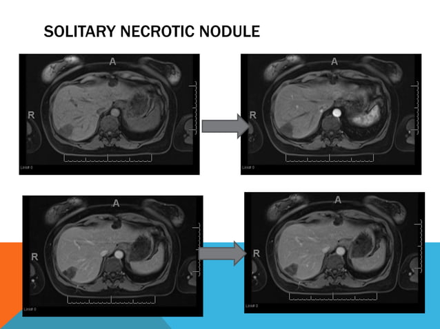 Quick review of hepatobiliary and pancreatic lesion | PPTX