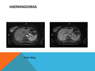 Quick review of hepatobiliary and pancreatic lesion | PPTX