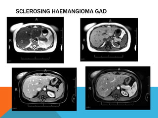 Quick review of hepatobiliary and pancreatic lesion | PPTX