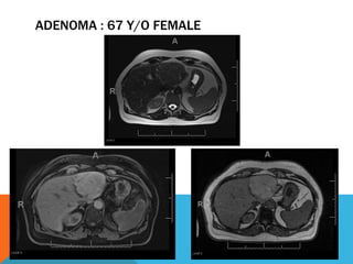 Quick review of hepatobiliary and pancreatic lesion | PPTX