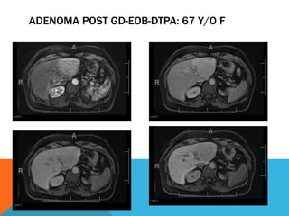 Quick review of hepatobiliary and pancreatic lesion | PPTX