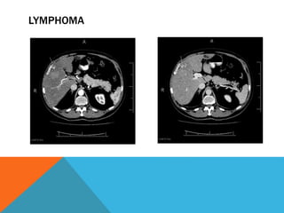 Quick review of hepatobiliary and pancreatic lesion | PPTX