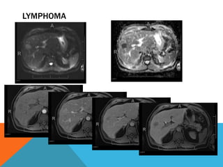 Quick review of hepatobiliary and pancreatic lesion | PPTX