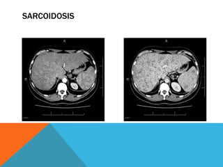Quick review of hepatobiliary and pancreatic lesion | PPTX