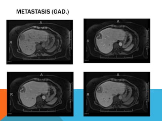 Quick review of hepatobiliary and pancreatic lesion | PPTX