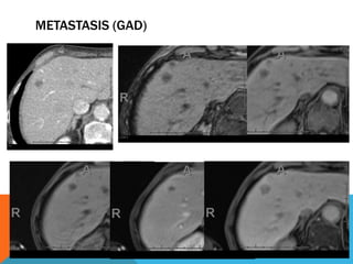Quick review of hepatobiliary and pancreatic lesion | PPTX
