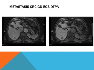 Quick review of hepatobiliary and pancreatic lesion | PPTX