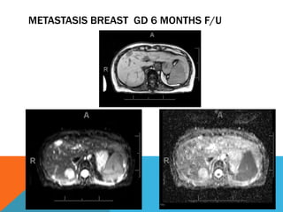 Quick review of hepatobiliary and pancreatic lesion | PPTX