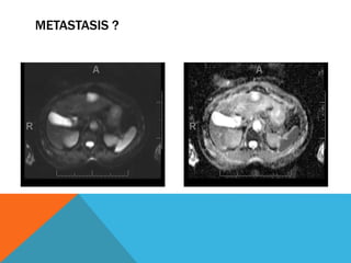 Quick review of hepatobiliary and pancreatic lesion | PPTX
