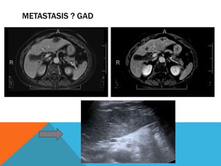 Quick review of hepatobiliary and pancreatic lesion | PPTX