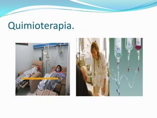 Quimioterapia | PPTX