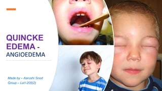 Quincke's edema Pediatrics Aarushi Sood.pptx