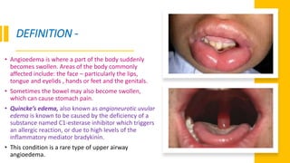 Quincke's edema Pediatrics Aarushi Sood.pptx