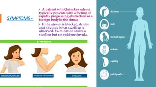 Quincke's edema Pediatrics Aarushi Sood.pptx