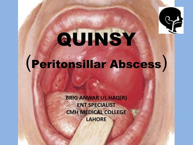 Quinsy or Peritonsillar Abscess | PPTX