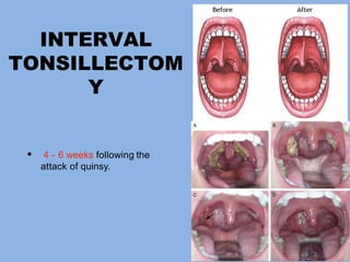Quinsy or Peritonsillar Abscess | PPTX