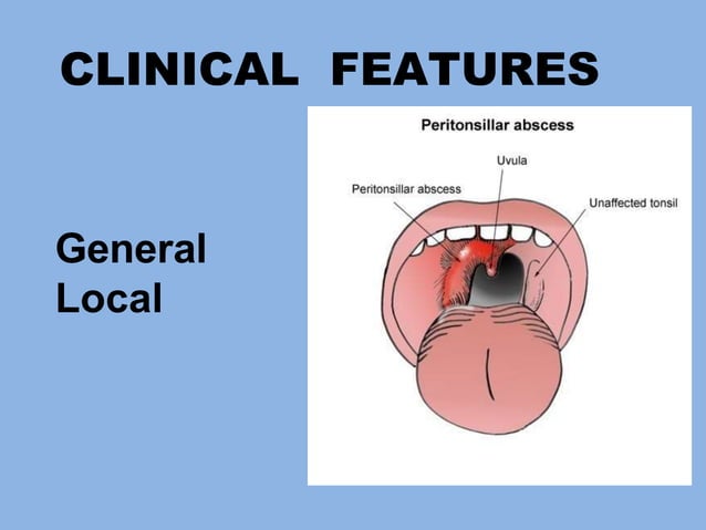 Quinsy or Peritonsillar Abscess | PPTX