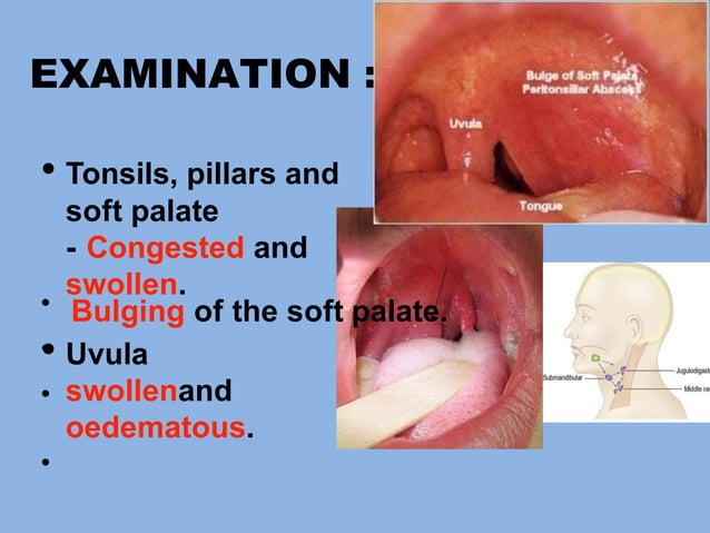 Quinsy or Peritonsillar Abscess | PPTX