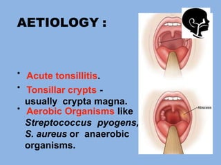 Peritonsillar Abscess Anatomy