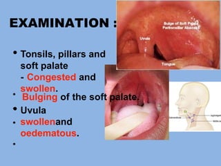 Peritonsillar Abscess