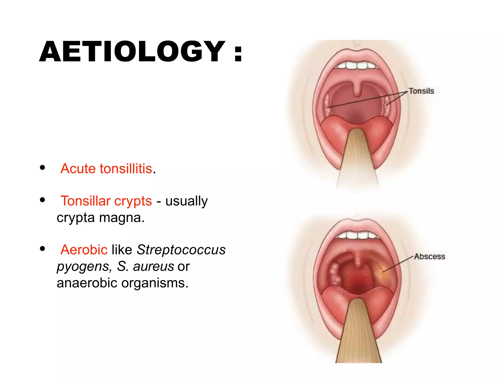 Quinsy or Peritonsillar Abscess.pptx