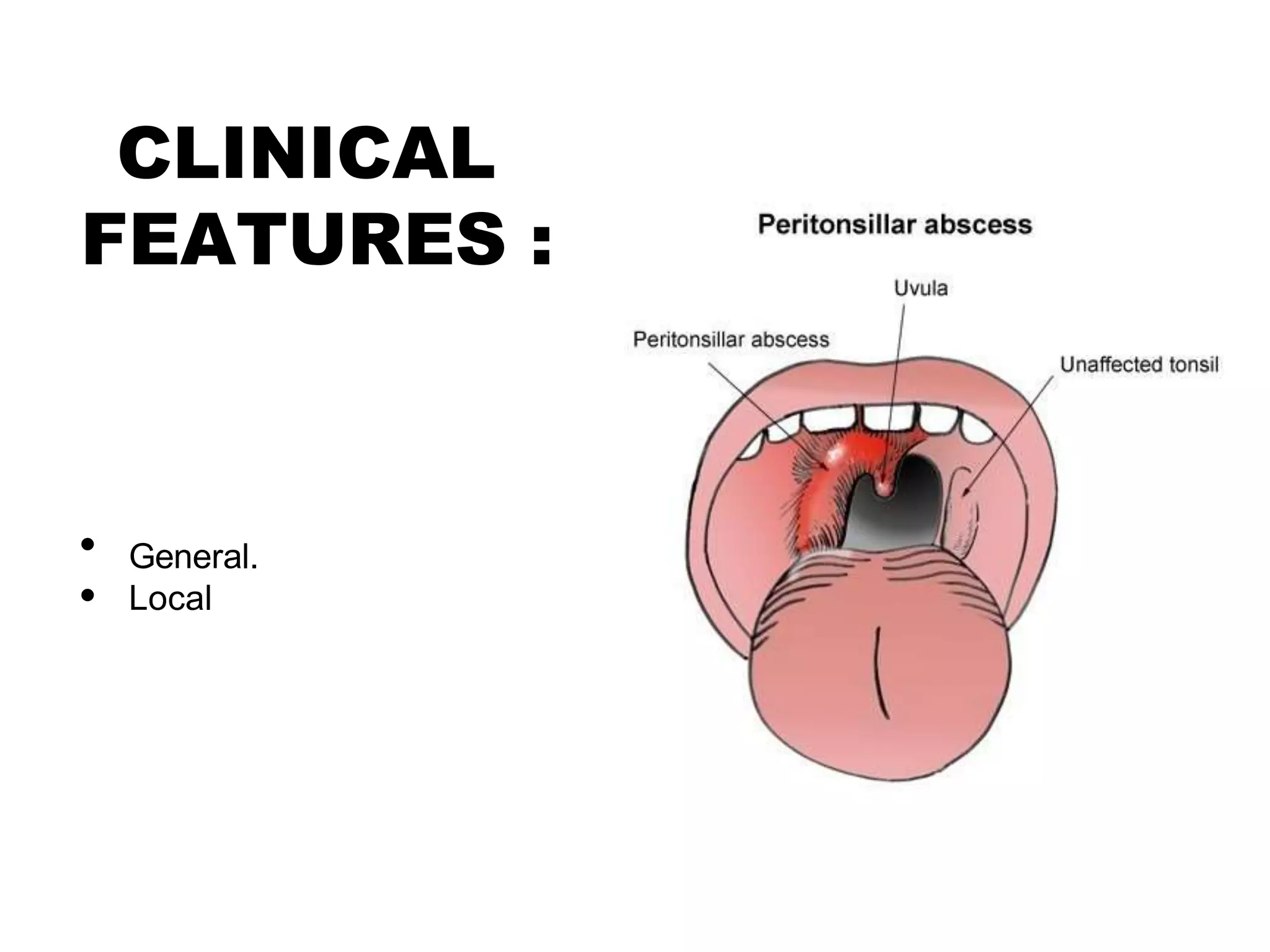 Quinsy or Peritonsillar Abscess.pptx