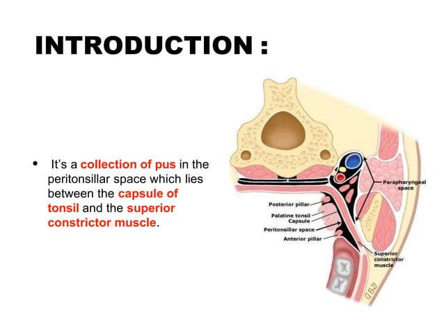 Quinsy or Peritonsillar Abscess.pptx