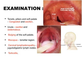 Quinsy or Peritonsillar Abscess.pptx