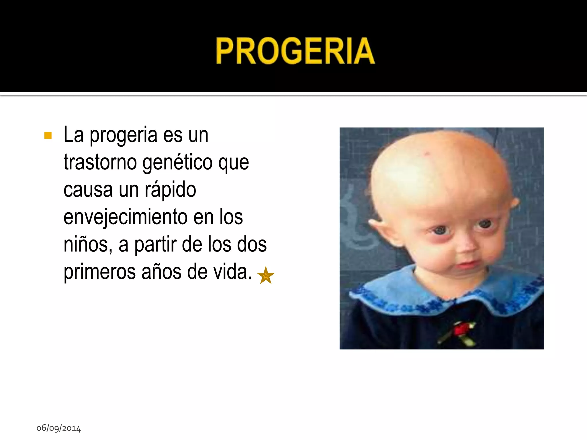 Síndrome de progeria | PPT