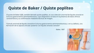 Quiste de Baker - Quiste de Baker - Quiste de Baker | PPTX