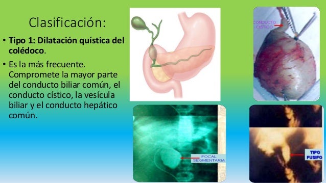 Quiste de coledoco