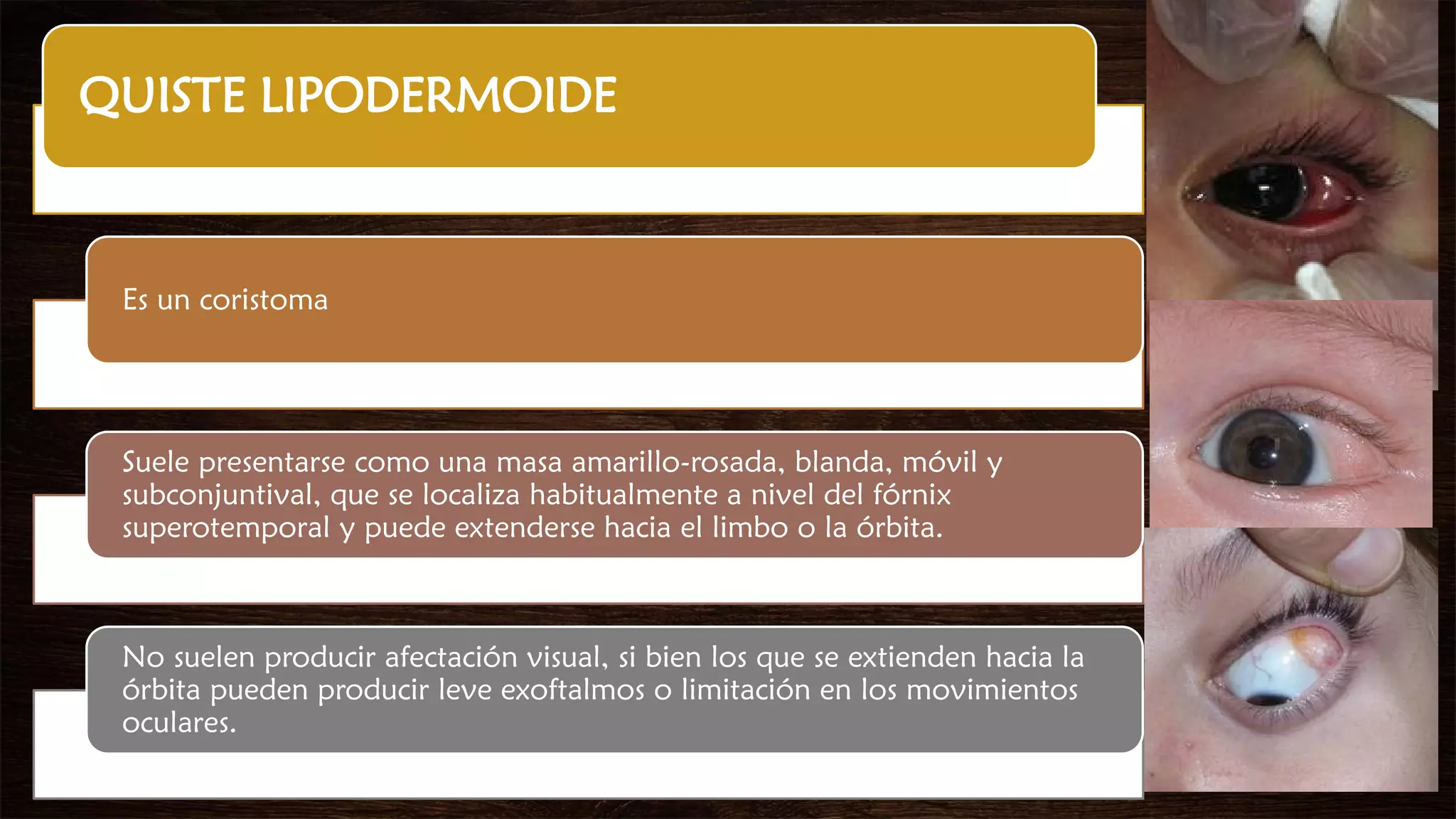 Quiste dermoide y Lipodermoide | PDF | Surgery | Medical Health