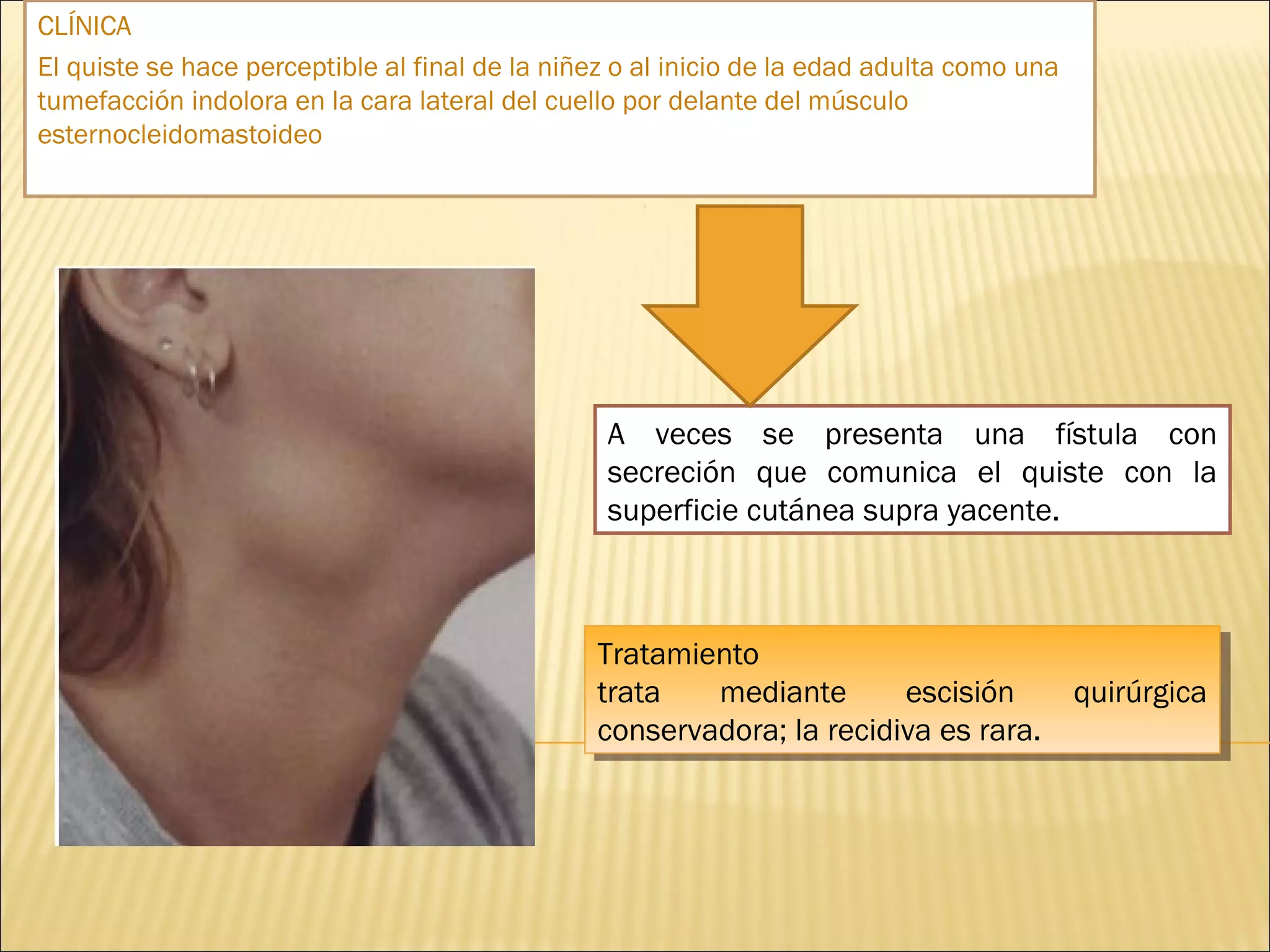 Quiste linfoepitelial cervical 2003 | PPT