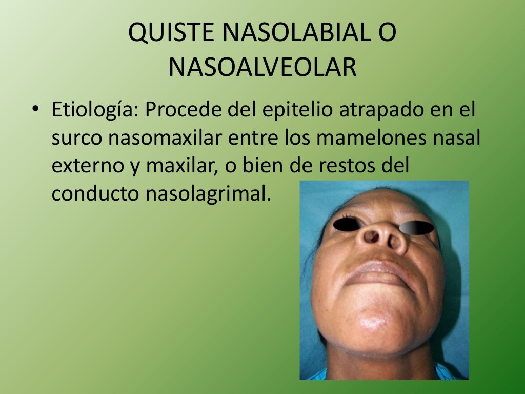 Quiste nasolabial y nasopalatino