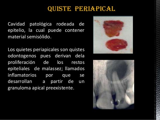 Quiste periapical