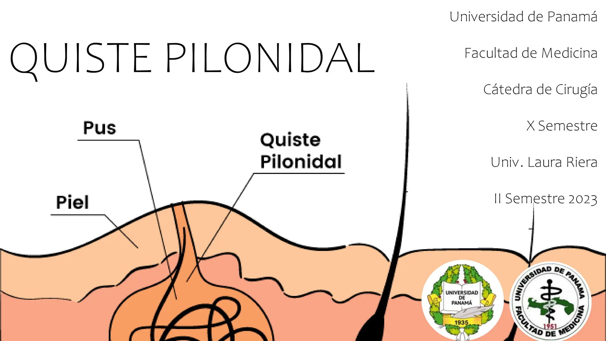QUISTE PILONIDAL CIRUGÍA LAURA RIERA.pptx