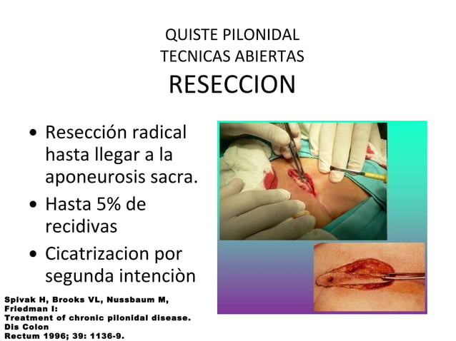 Enfermedad pilonidal