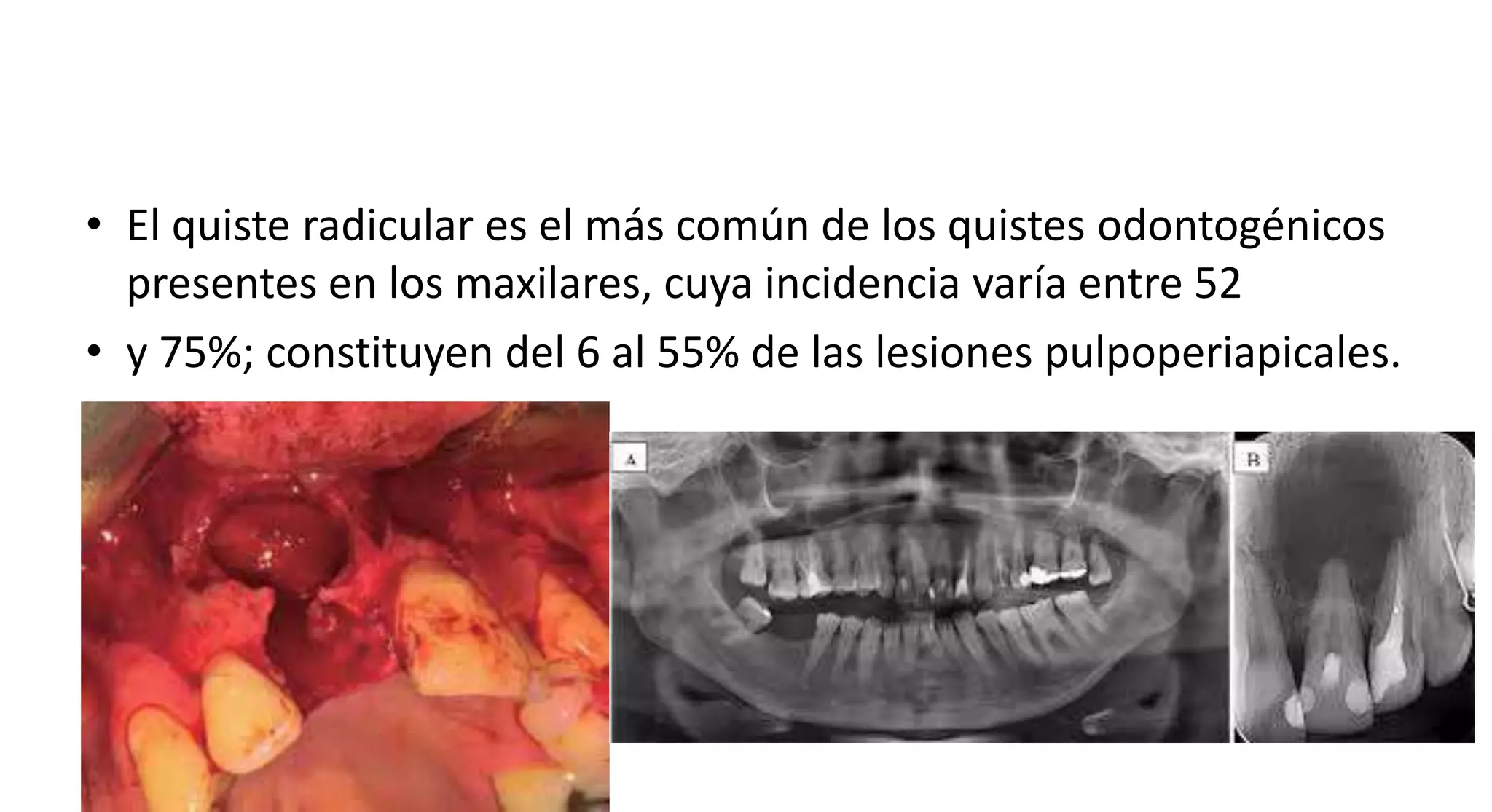 Quiste Radicular.pptx