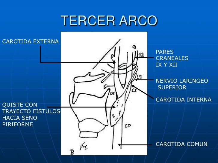 Quistes laterales cervicales