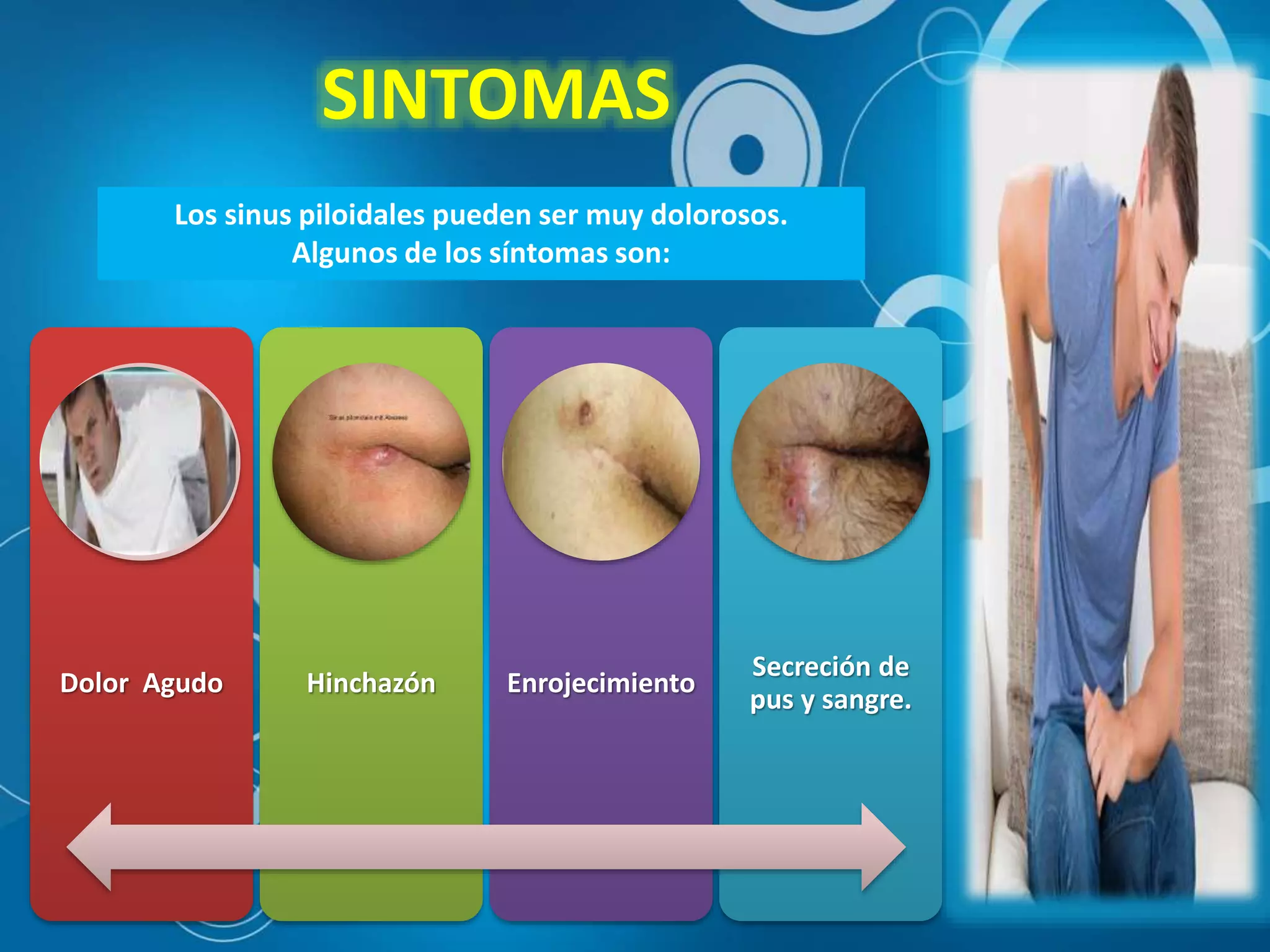 Quistes pilonidal | PPTX