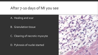 QUIZ: Pathology of Ischemic Heart Disease | PPT