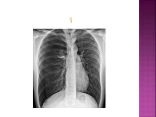Quiz chest xray | PPTX