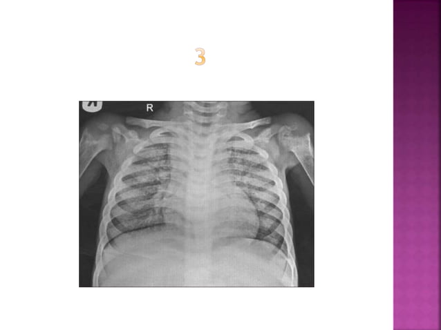 Quiz chest xray | PPTX