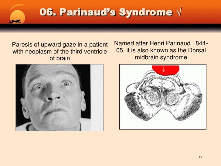 Parinaud Syndrome