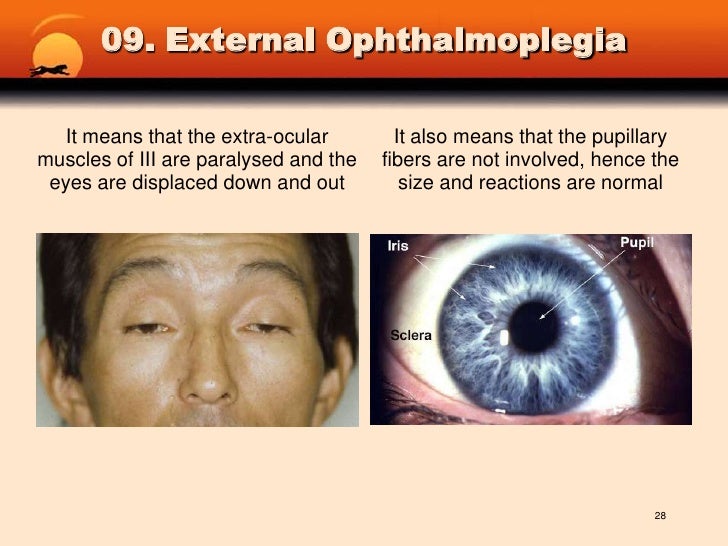 Quiz 25 On Ophthalmoplegia
